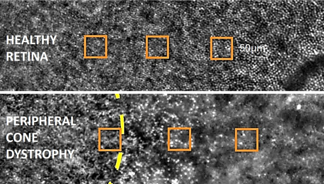 rtx1 clinical results in inherited diseases at JSCEV 2017 • Imagine Eyes