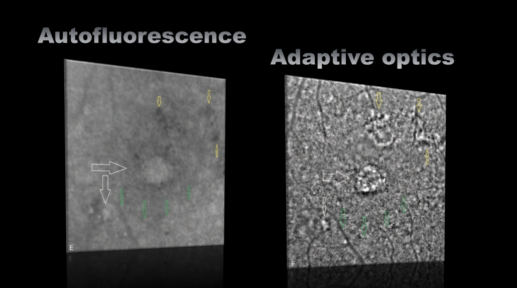 Retinal laser therapy assessed with adaptive optics imaging • Imagine Eyes