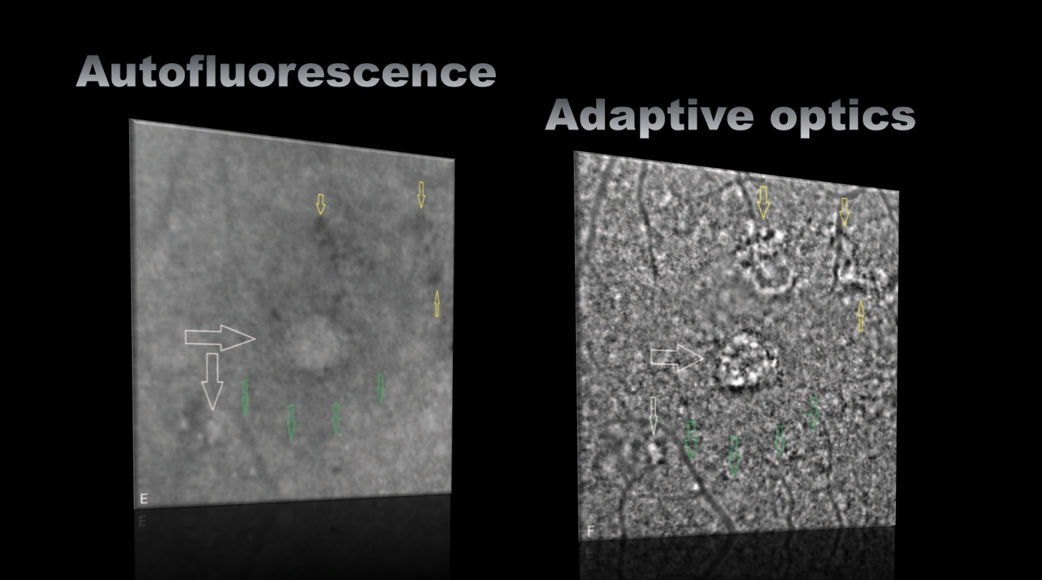 Retinal laser therapy assessed with adaptive optics imaging • Imagine Eyes