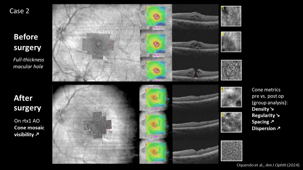 Cone cells before/after macular hole surgery • Imagine Eyes
