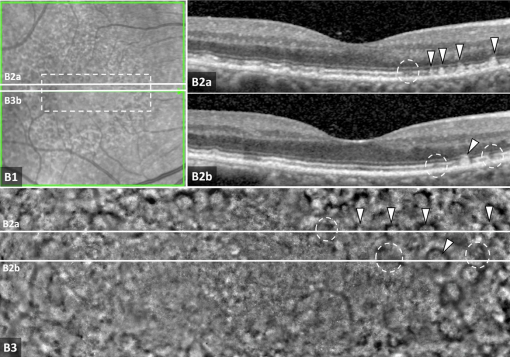 Early atrophic changes in AMD captured by rtx1 • Imagine Eyes