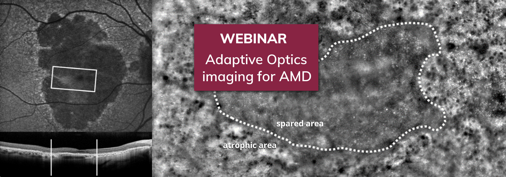 AO imaging in AMD: towards personalized medicine • Imagine Eyes